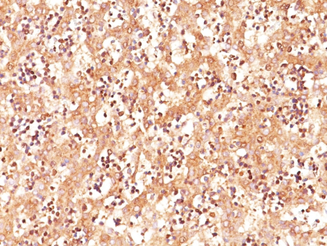 AFP (Alpha Fetoprotein) (Hepatocellular/Germ Cell Tumor Marker ...